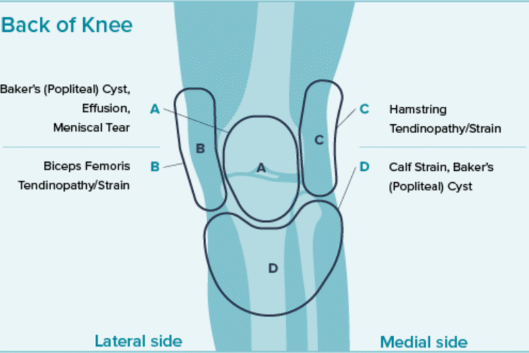 Knee Pain Location Chart: A Visual Guide